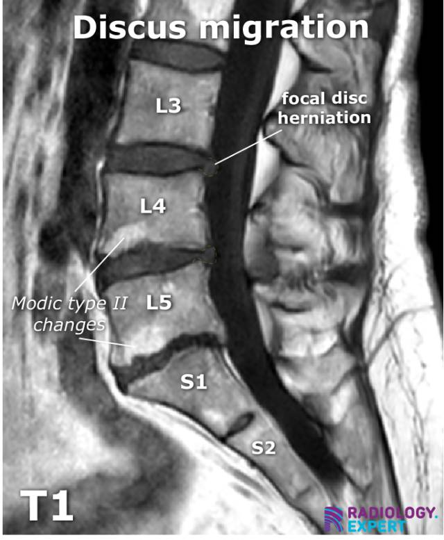 MRI Lumbar Spine